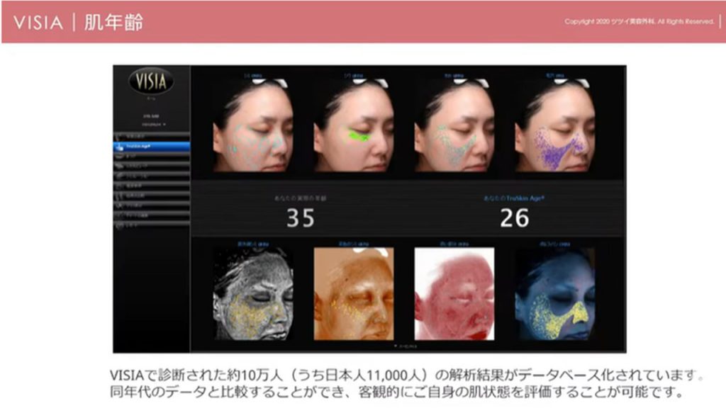 VISIAで肌診断【院長が動画で解説】 | 大阪のツツイ美容外科・美容皮膚科（心斎橋）